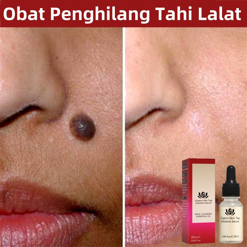 Jual penghilang tahi lalat Krim kutil obat penghilang kutil skin tag ...
