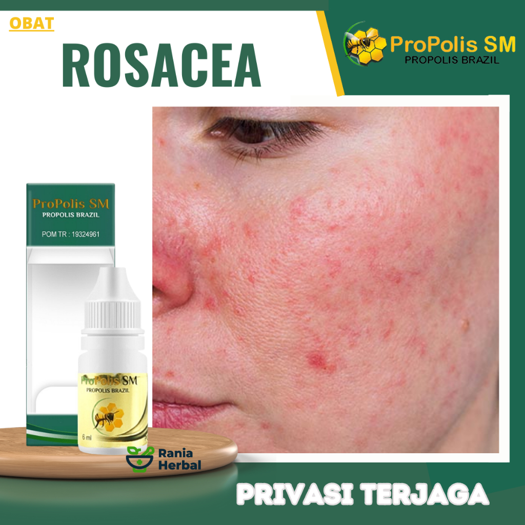 Jual Obat Rosacea, Obat Kulit Kemerahan, Obat Peradangan Kulit, Obat ...