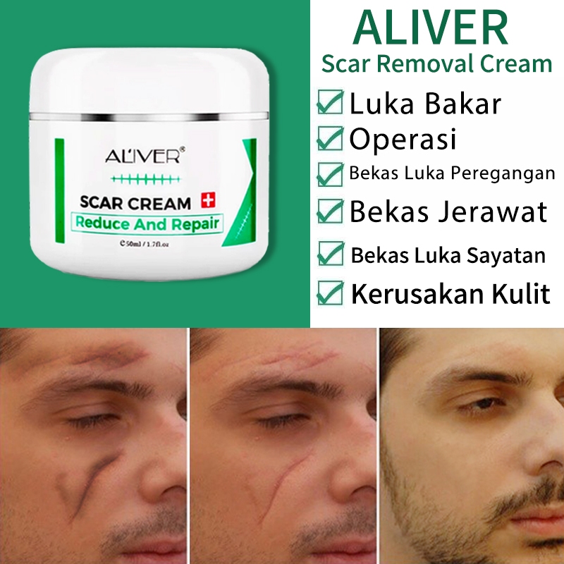Jual ALIVER Scar Cream Removal 50g Luka bakar Gigitan serangga Stretch ...