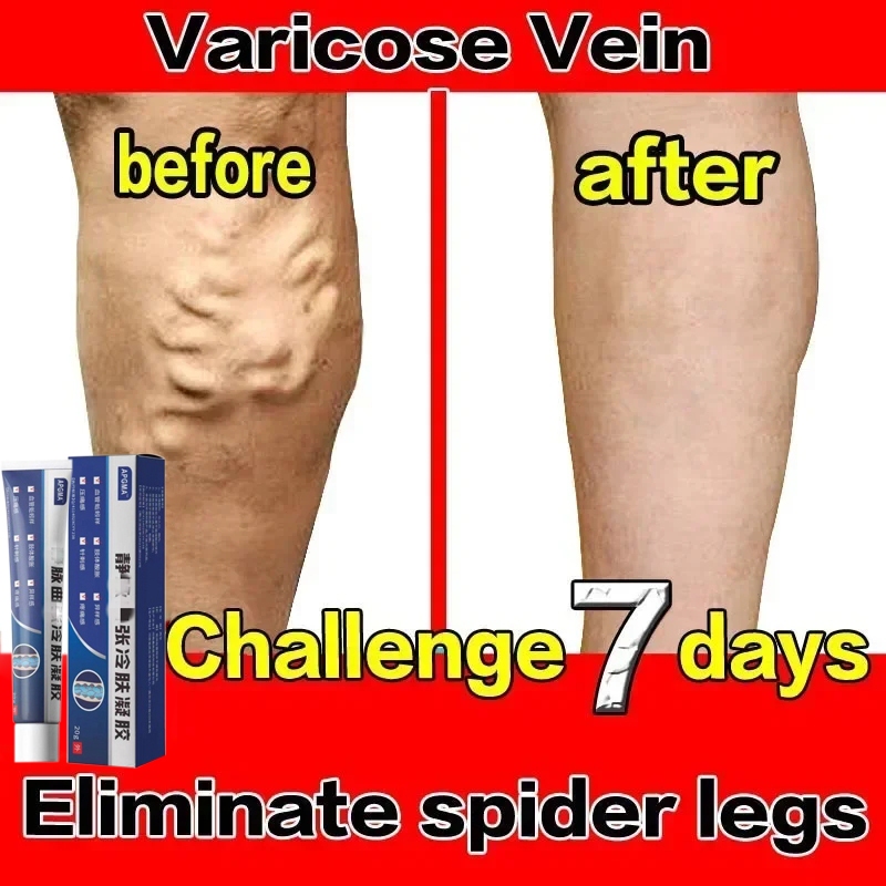 Jual ORI APGMA Varicose Veins Cream Obat Varises Salep Penghilang ...