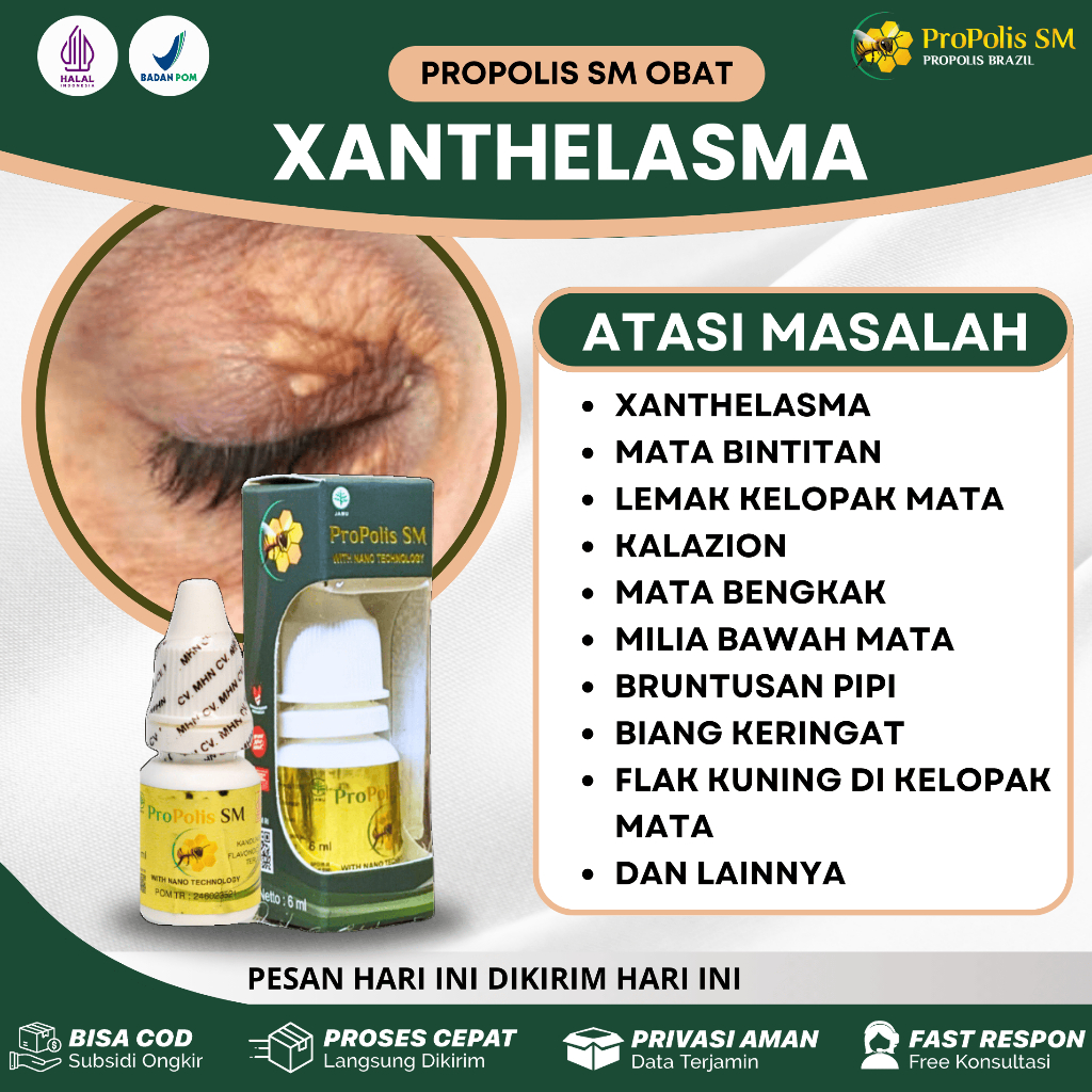 Jual Obat Xanthoma xanthelasma Plak Kuning Gumpalan Lemak Kelopak Mata ...