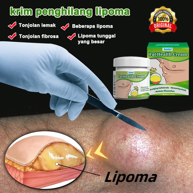Jual 【100% asli】krim penghilang lipoma Lipoma cream Salep benjolan ...