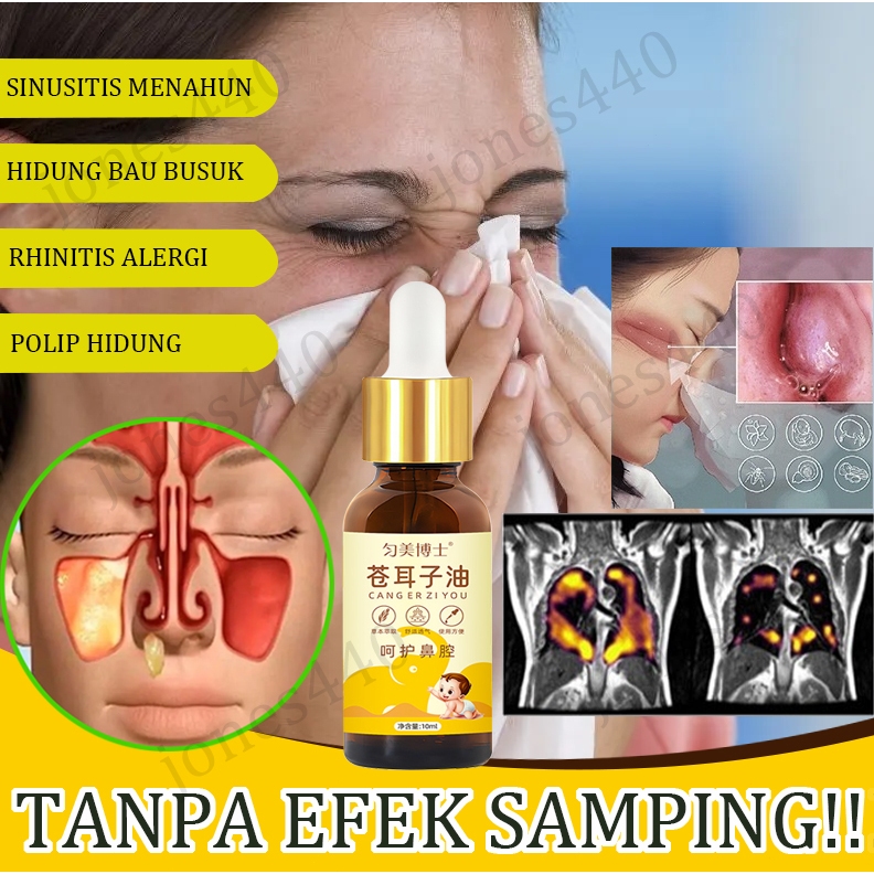 Jual Obat Polip Hidung, Benjolan Didalam Hidung, Sinusitis Hidung Akut ...