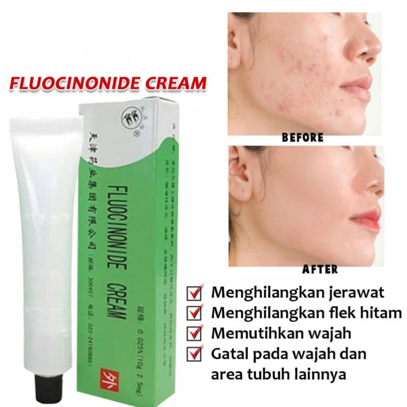Jual Obat Salep Cream Walet Sriti Original Fluocinonide Cream | Shopee ...