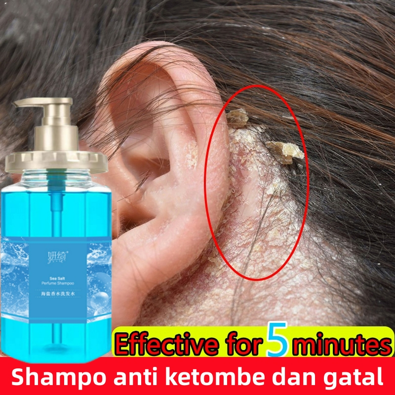 Jual Shampo Anti Ketombe Dan Rambut Rontok Obat Ketombe Sampo Anti Ketombe Dan Gatal Shampo ...