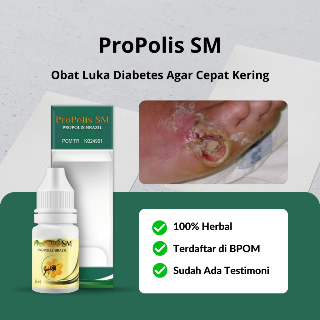 Jual Propolis SM - Obat Luka Diabetes, Obat Luka Basah, Obat Luka ...