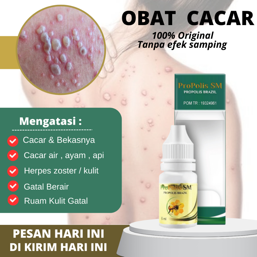 Jual Propolis SM - Obat cacar air & bekas cacar, Obat herpes zoster ...