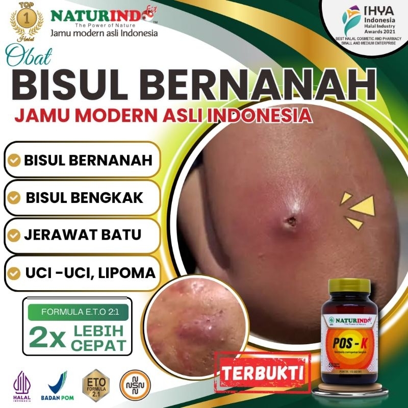Jual Obat Bisul Bernanah Bisul Bengkak Bisul Pecah Berdarah Cenang ...