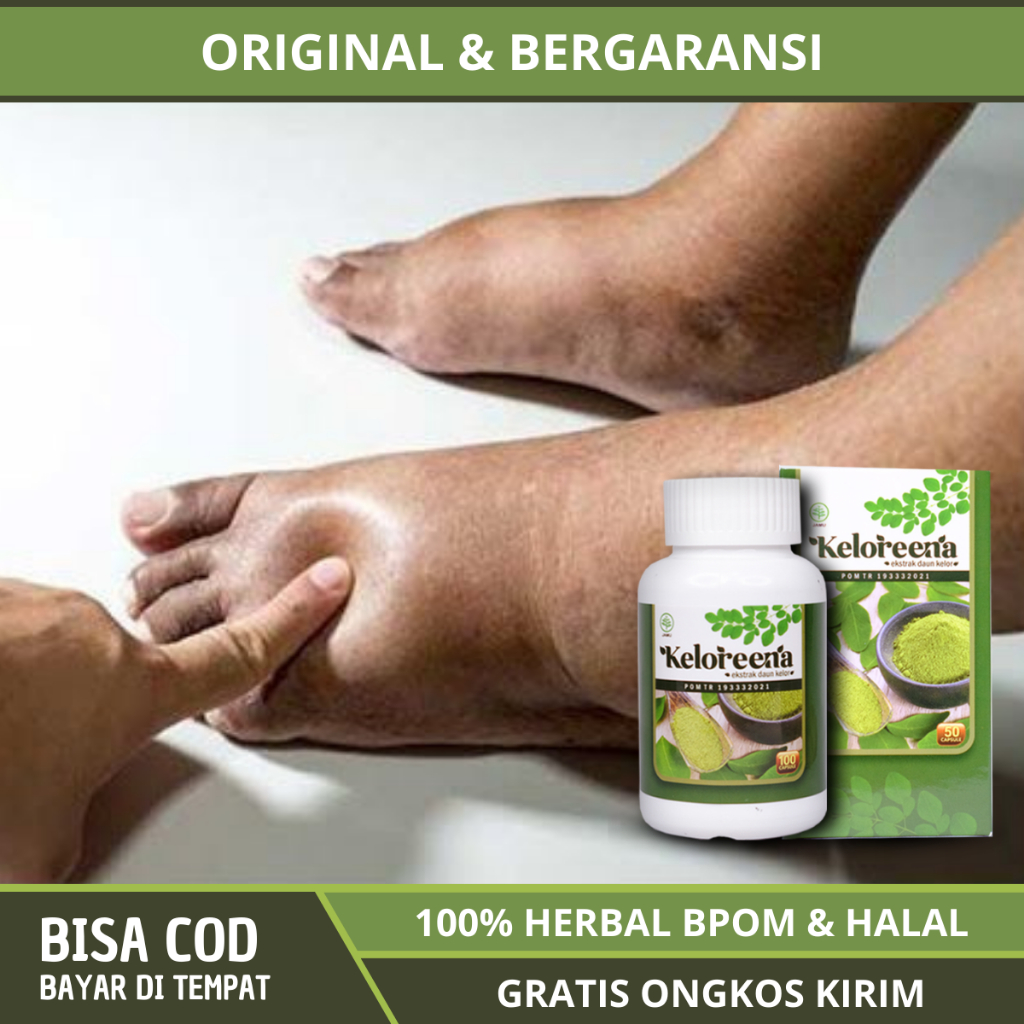 Jual Obat Kaki Bengkak Karena Gula / Diabetes, Asam Urat, Ginjal ... Jual Obat Kaki Bengkak Karena Gula / Diabetes, Asam Urat, Ginjal ...
