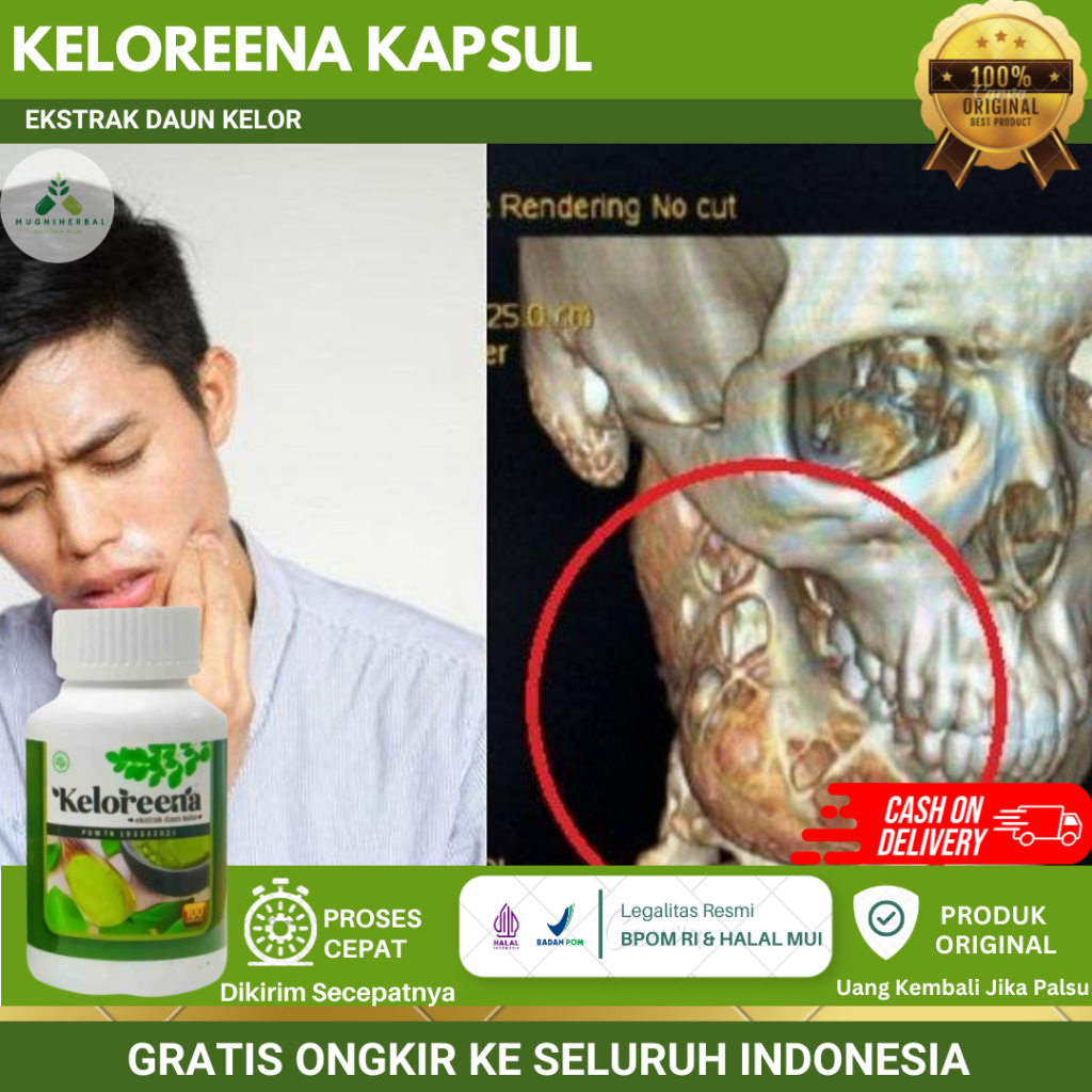 Jual Keloreena Kapsul 100% Original - Obat Tumor Rahang Bengkak ...
