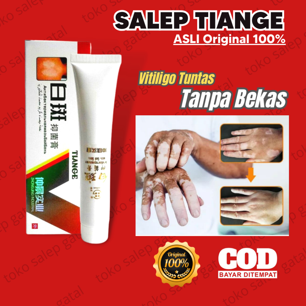 Jual [PROMO] OBAT SALEP TIANGE VITILIGO PENGHILANG BERCAK PUTIH | SALEP ...