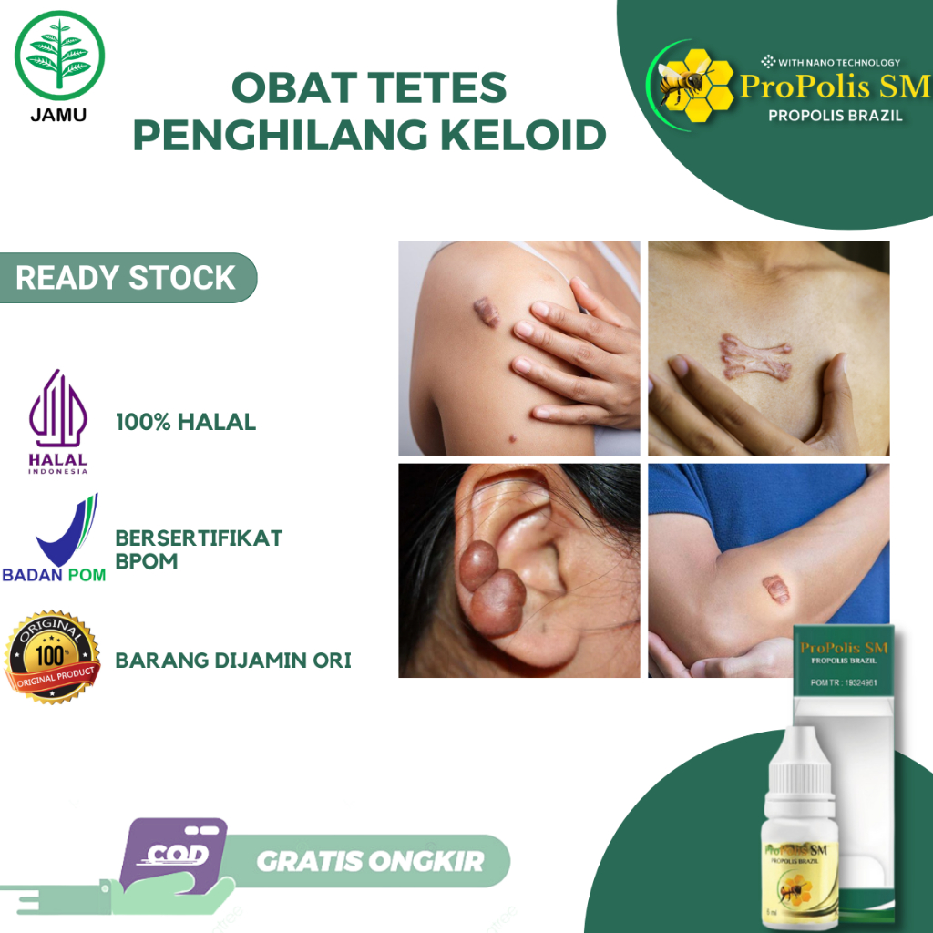 Jual Obat Penghilang Keloid Daging Tumbuh Bekas Luka Menonjol Keloid ...