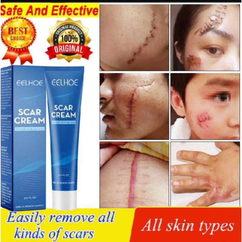 Jual Stretch Marks Remove Acne Spots Surgical Scars Penghilang Bekas ...