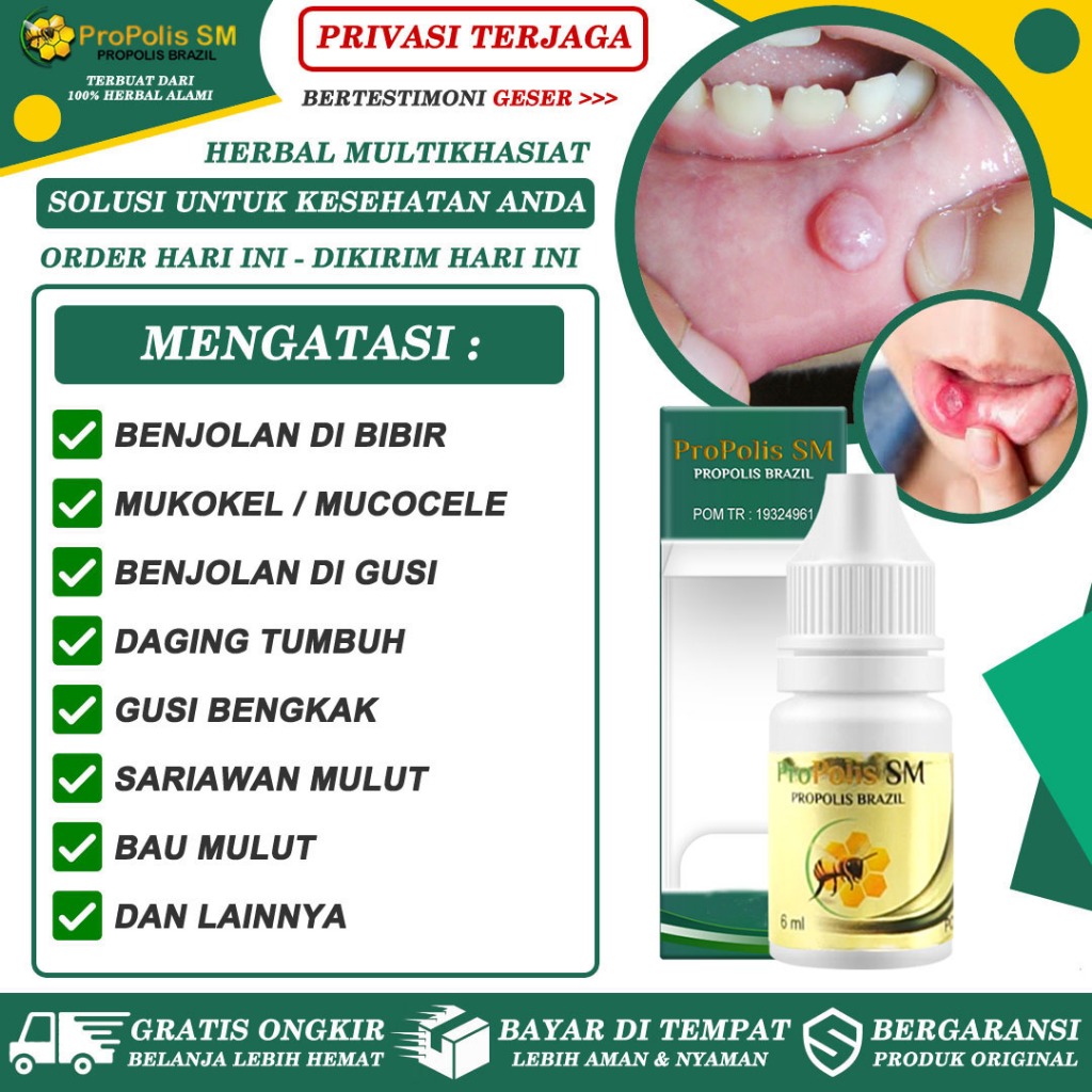 Jual Obat Benjolan Di Bibir Mukokel Mucocele Daging Tumbuh Pada Gusi ...