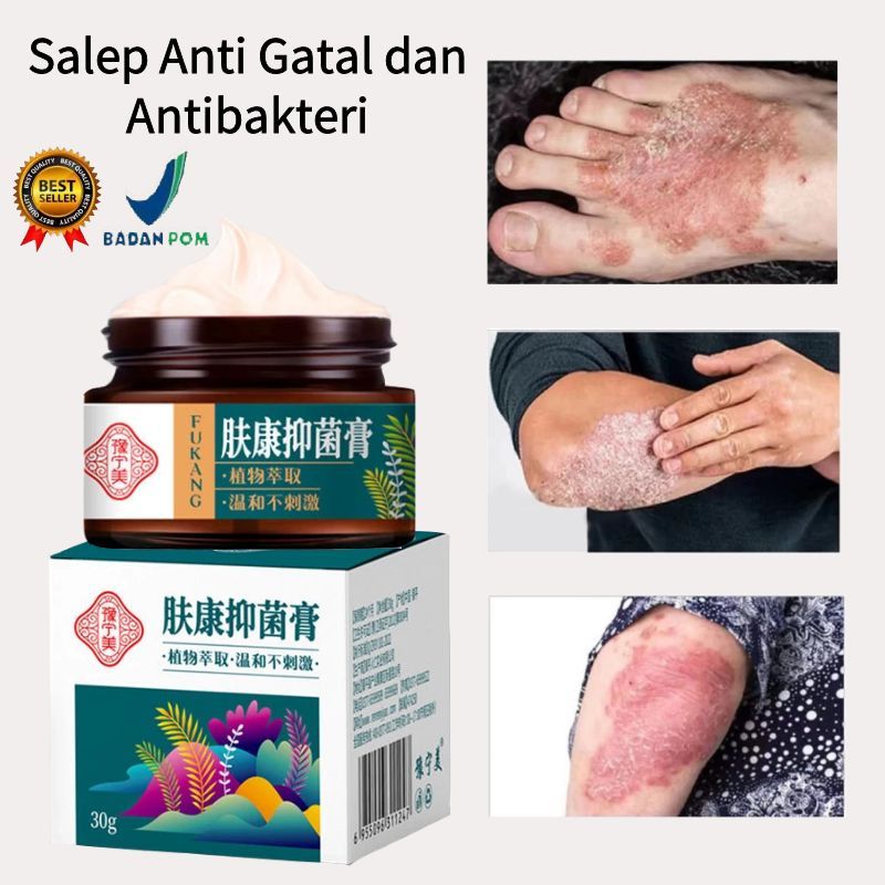 Jual [100% Original] Salep gatal paling ampuh psoriasis Obat Gatal Di ...