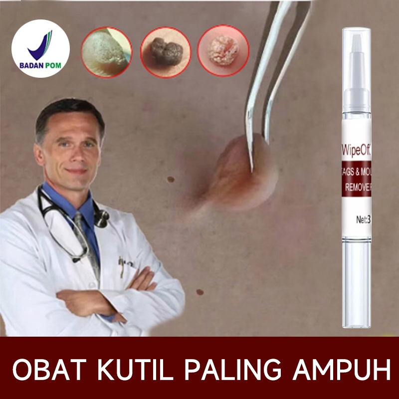 Jual Penghilang Kutil Dan Tahi Lalat Penghilang Kutil Di Wajah ...