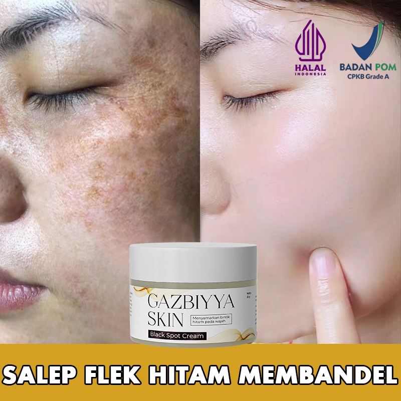 Jual Krim Penghilang Flek Hitam Cream Flek Hitam Membandel Salep Flek