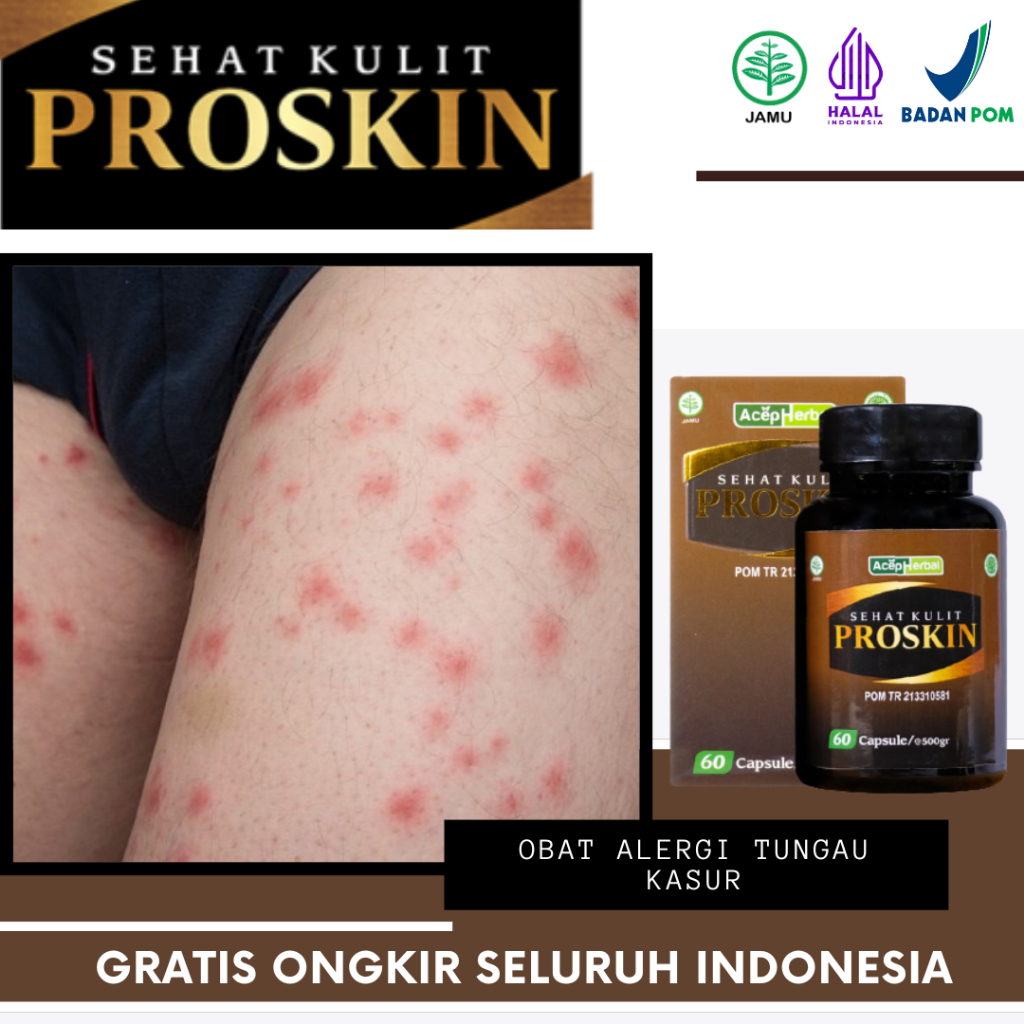Jual Obat Untuk Alergi Tungau Kasur, Alergi Kutu Kasur, Gatal di Gigit ...