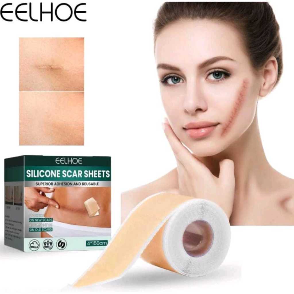 Jual Silicone Scar Sheet 4cm x 1.5m plester silikon penghilang keloid ...