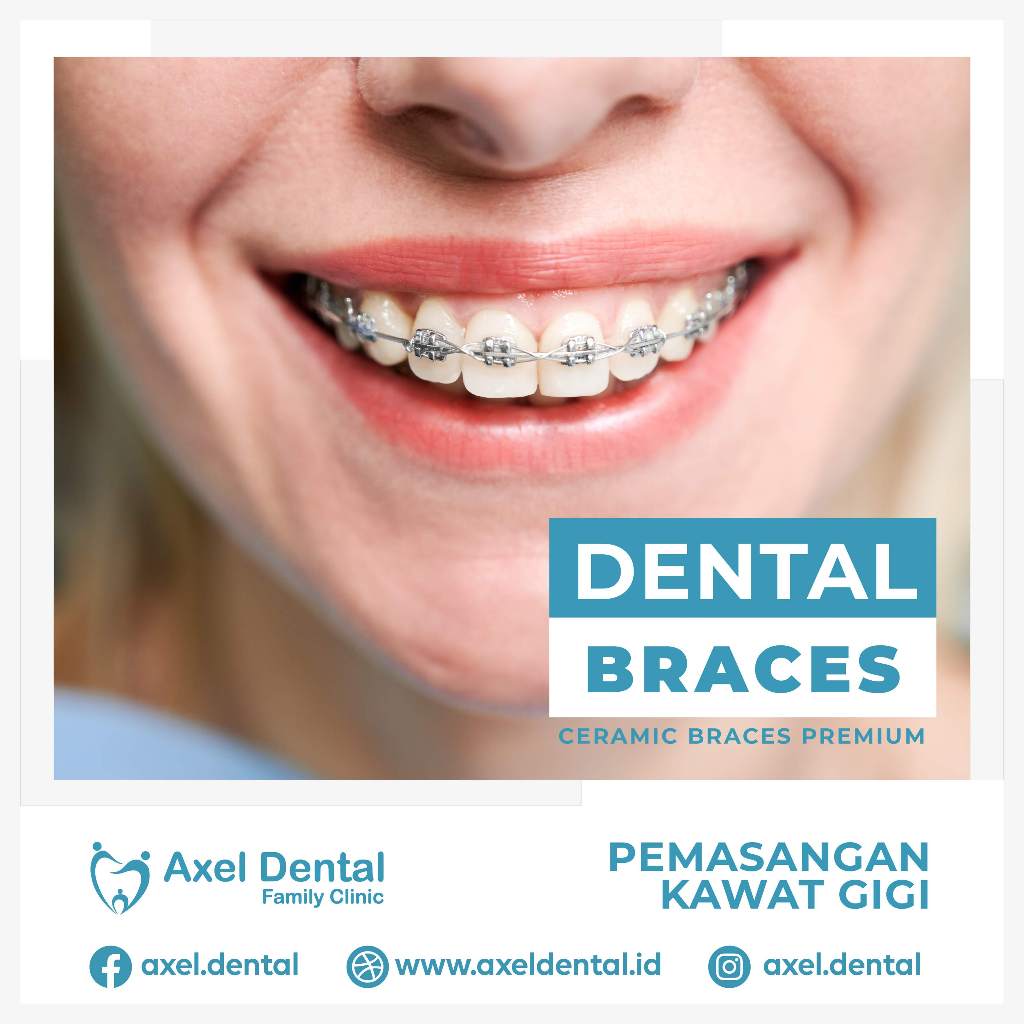 Jual Voucher Ceramic Braces Premium / Kawat Gigi Premium AXEL Dental ...