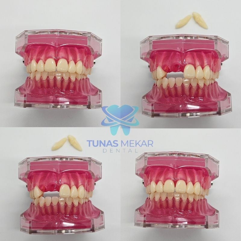 Jual Dental Model Study Studi Gigi Lepasan Phantom Pantum Gigi Lepas ...