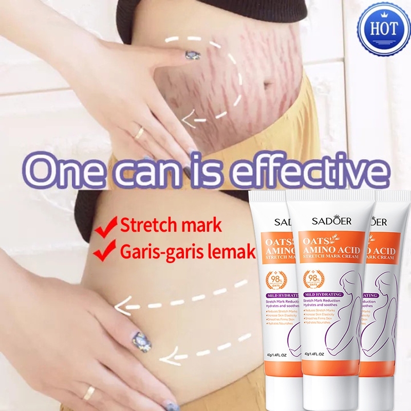 Jual Krim Penghilang Stretch Mark Postpartum Stretch Mark Cream Oatmeal ...