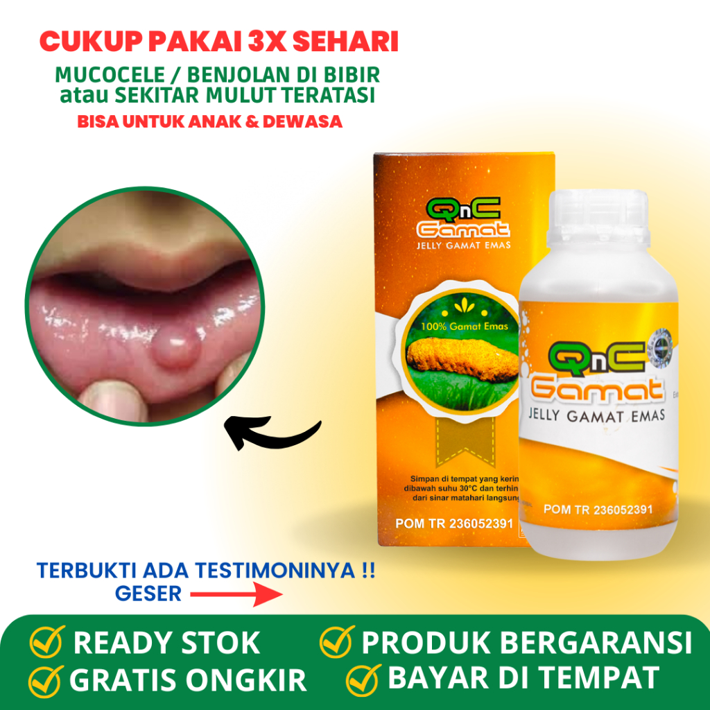 Jual Obat Salep Untuk Mucocele, Mukokel,Kista Di Mulut, Benjolan Di ...