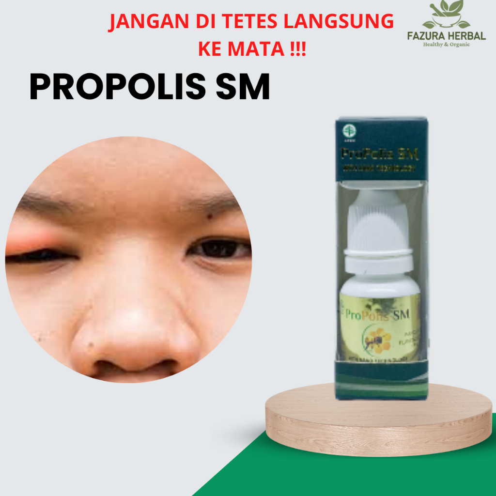 Jual Obat Kelopak Mata Bengkak, Kelopak Mata Membesar, Kelopak Mata ...