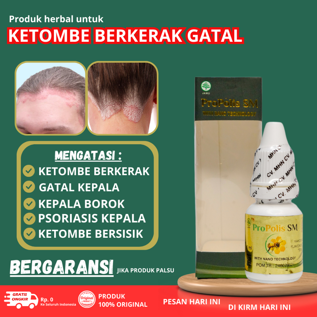 Jual Obat Jamur Kepala Kering - Salep Borok Kepala - Obat Psoriasis Kulit Kepala - Obat Kepala ...