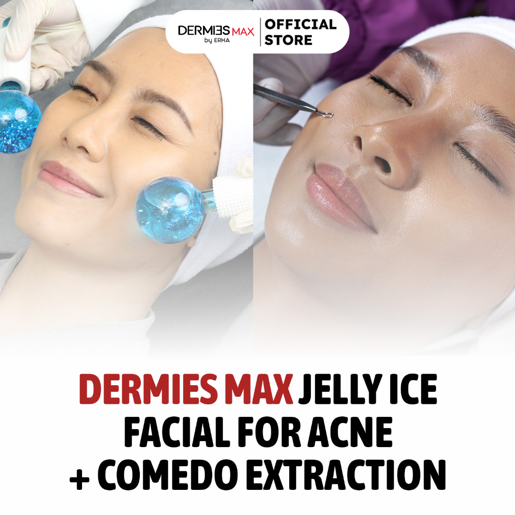 Jual Dermies Max Jelly Ice Facial for Acne + Comedo Extraction | Shopee ...