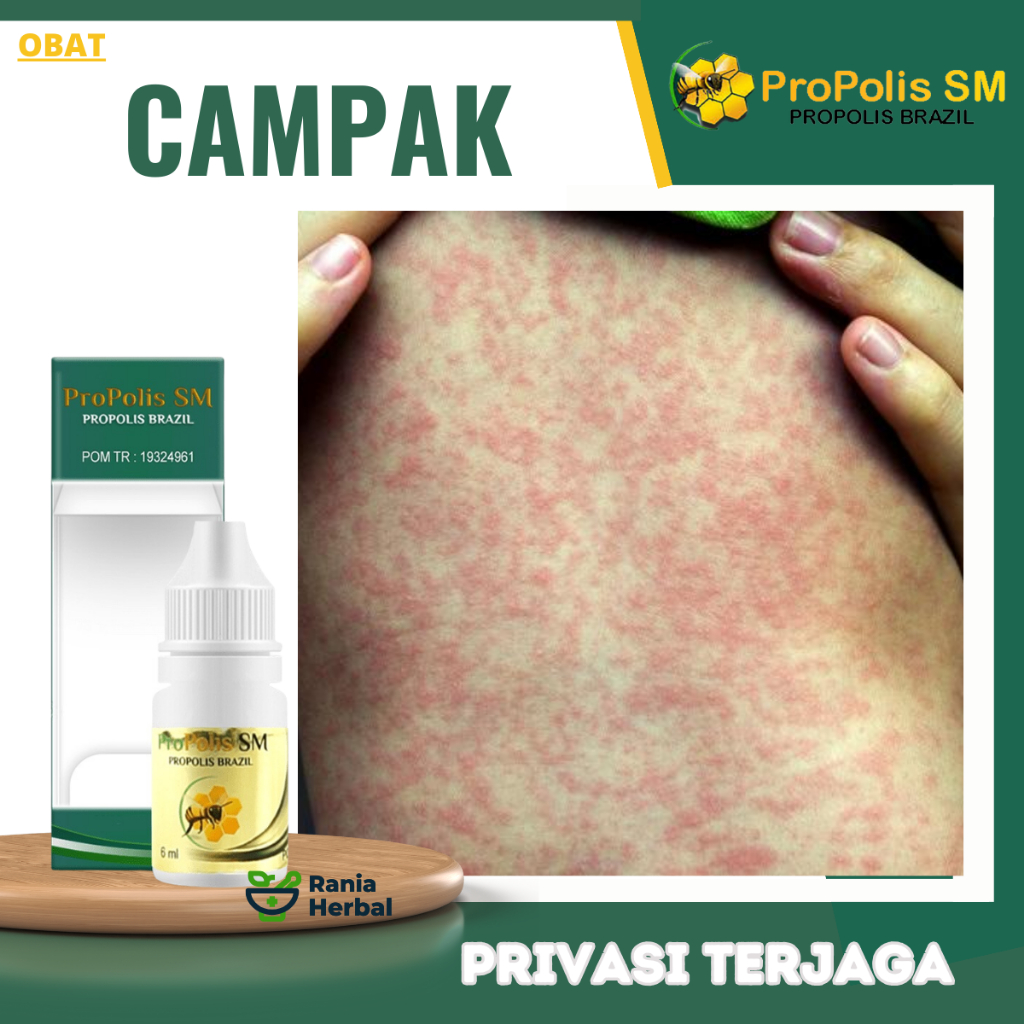 Jual Obat Campak, Salep Campak Anak Dan Dewasa, Obat herpes zoster ...