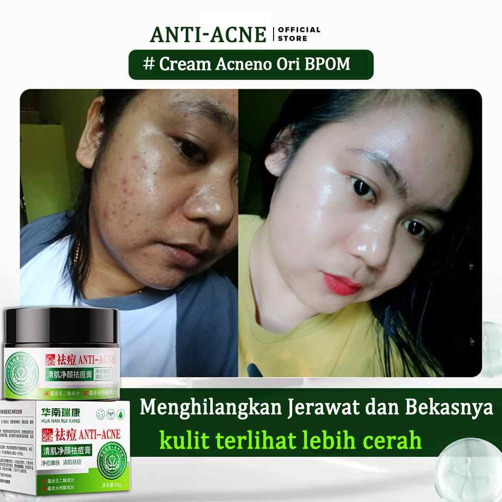 Jual Acne Cream Obat Jerawat Ampuh Salep Jerawat Dan Bekas Jerawat 30g ...
