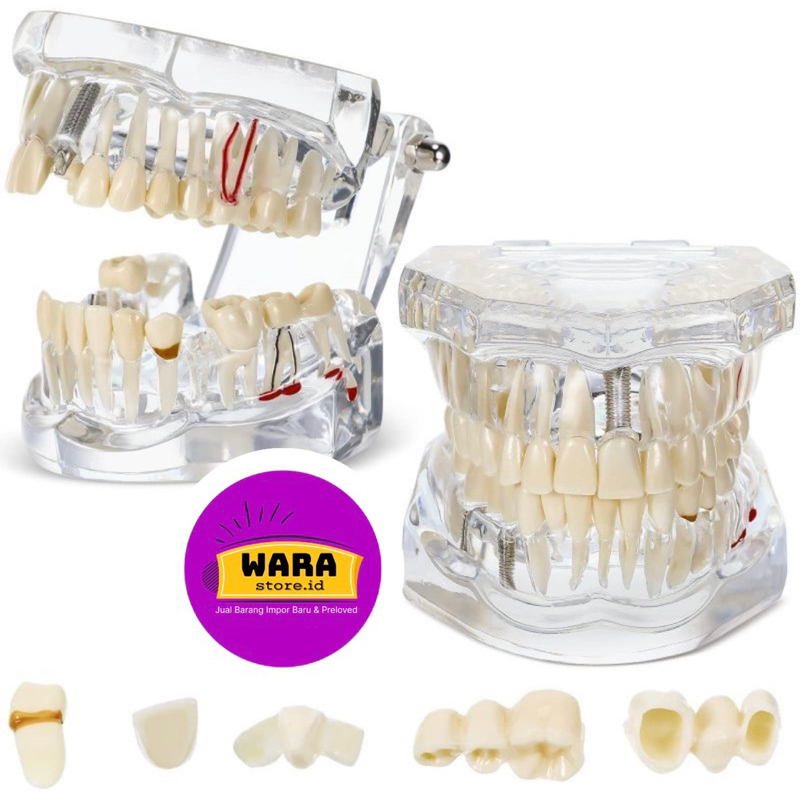 Jual Dental study karies model gigi phantom replika tiruan edukasi ...