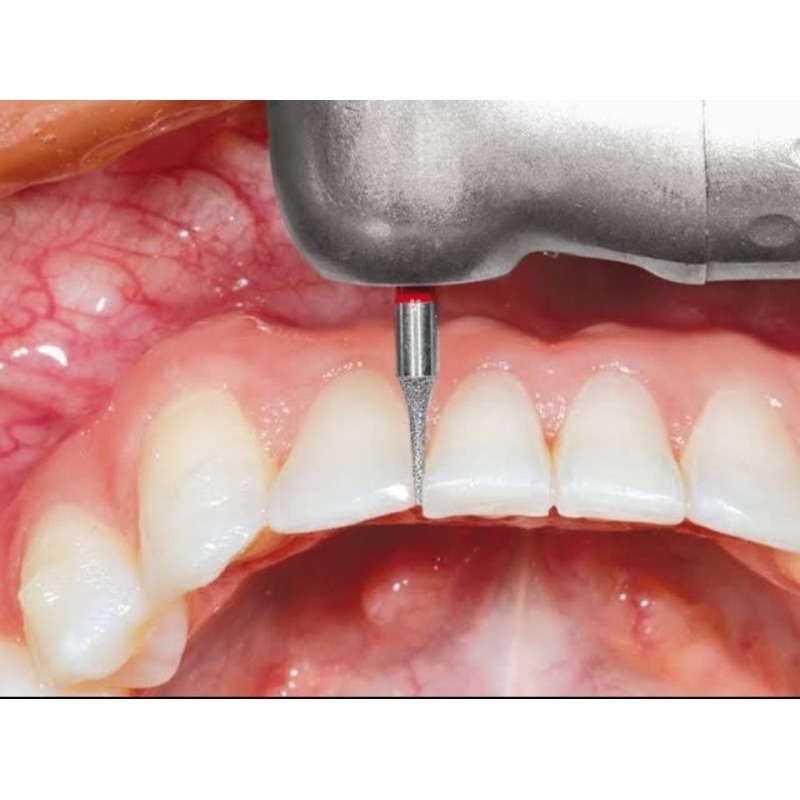 Jual Dental Mosquito Ortho Diamond Bur Slicing Stripping Proximal Space ...