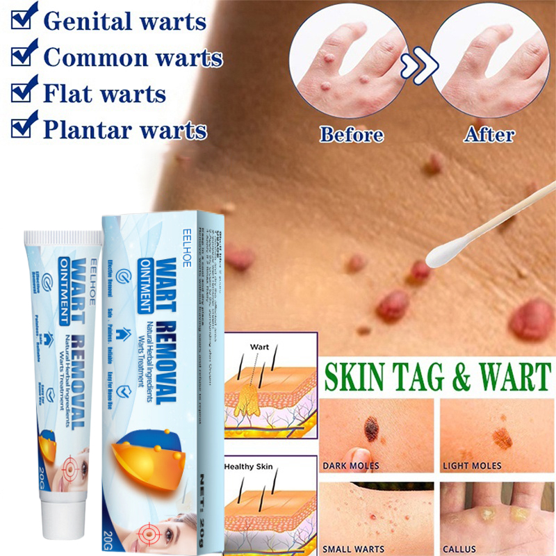 Jual Salep Obat Kutil Paling Wart Removal Cream Penghilang Tahi Lalat ...