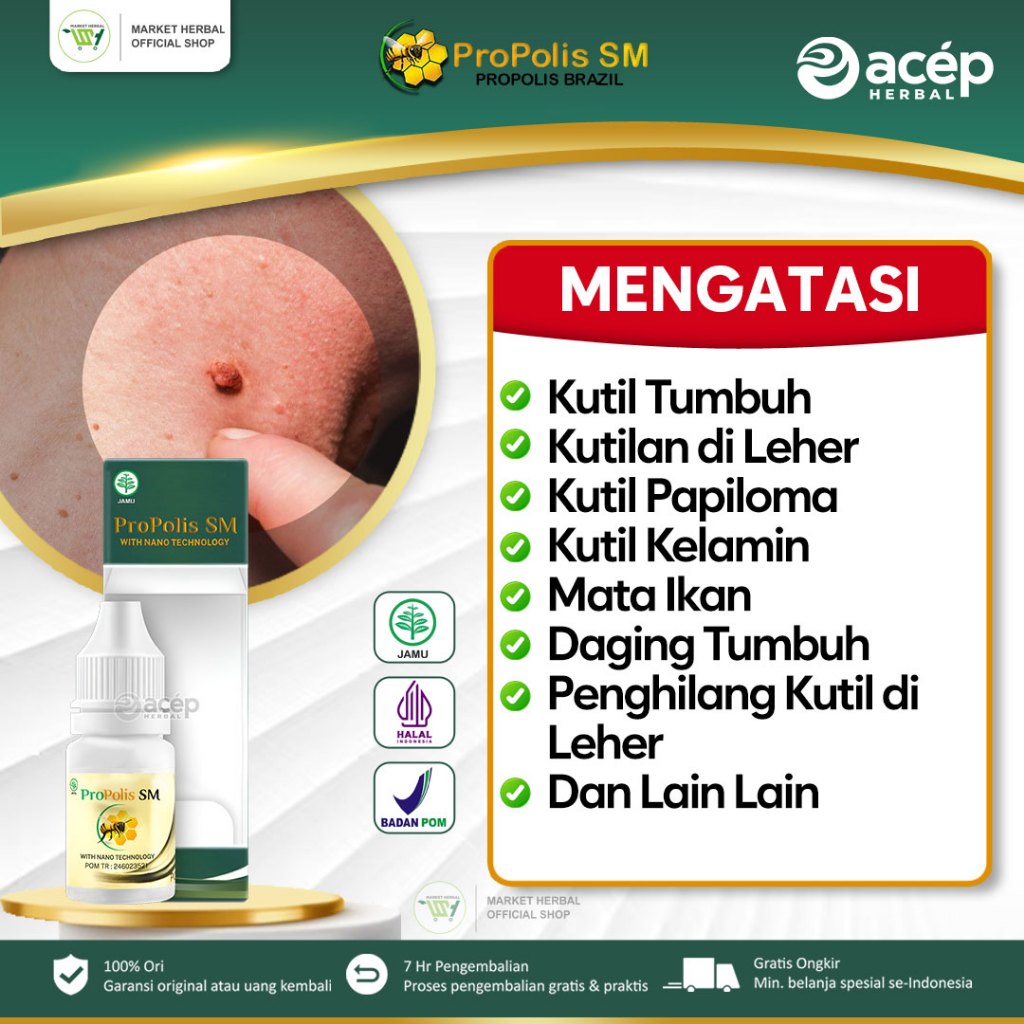 Jual Obat Daging Jadi, Kutil Kelamin, Skin Tag, Papiloma, Keloid, Milia ...