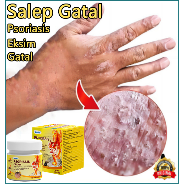 Jual Obat gatal kulit Salep eksim Salep psoriasis Obat gatal ... Jual Obat gatal kulit Salep eksim Salep psoriasis Obat gatal ...