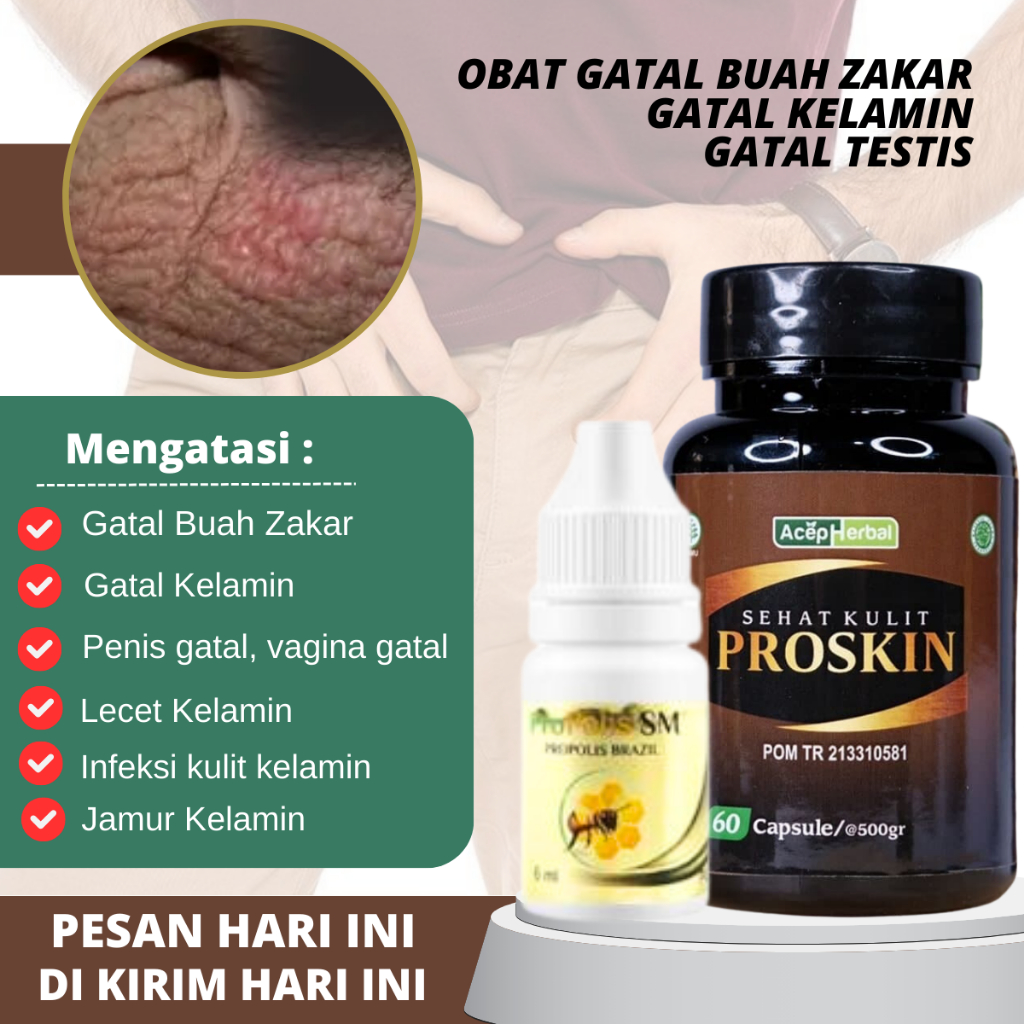 Jual Propolis SM - Obat Ruam Di Buah Zakar, Obat Gatal Biji Pelir, Obat ...