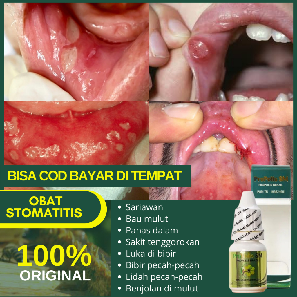 Jual Obat Stomatitis Radang Mukosa Mulut Sariawan Mulut Bengkak ...