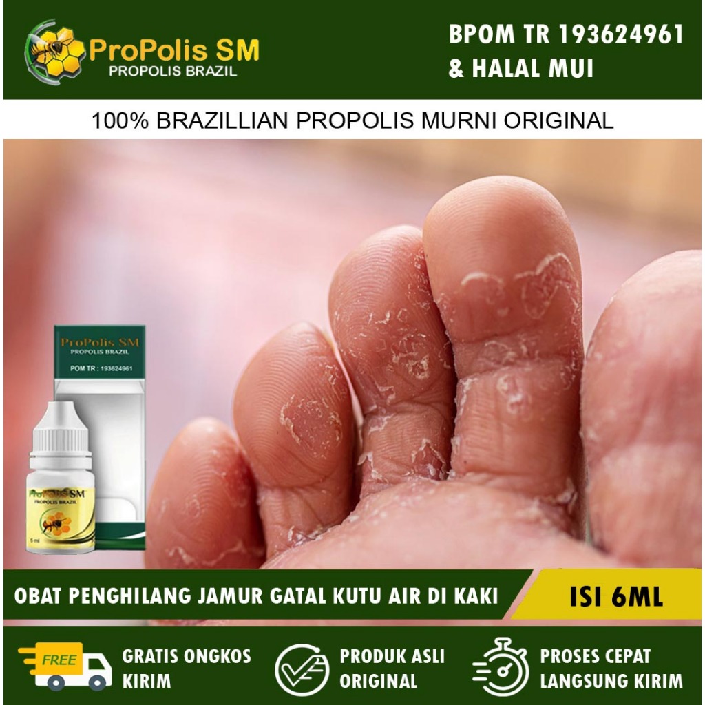 Jual Obat Jamur Gatal Kutu Air, Obat Kutu Air Pada Telapak Kaki, Jamur ...