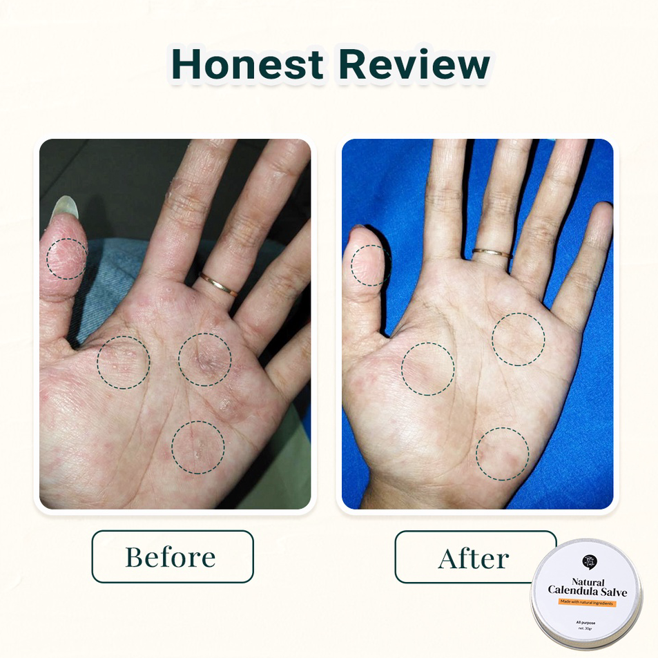 Jual Model Terkini Biotalk Natural Calendula Salve | No Steroid | Salep ...