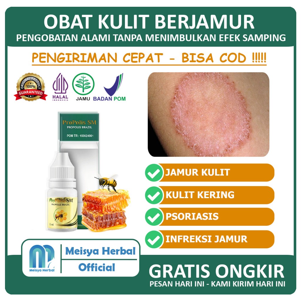Jual Obat Jamur Kulit Gatal Gatal Alergi Kurap Selangkangan Infeksi ...