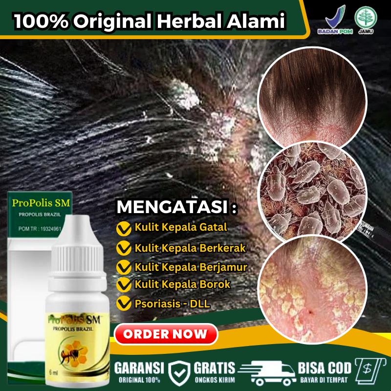 Jual Obat Psoriasis di Kulit Kepala, Penghilang Gatal Ketombe Berkerak di Kulit Kepala 100% ...