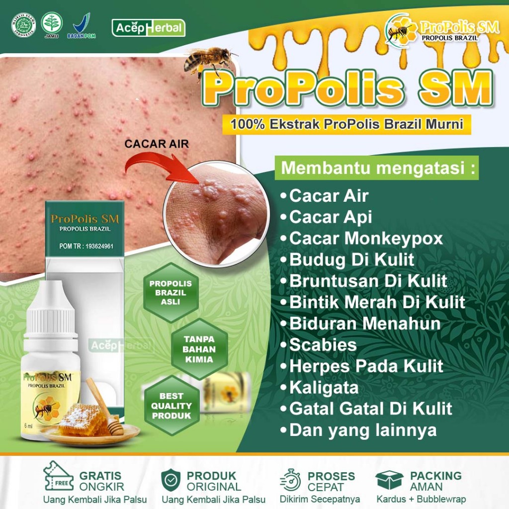 Jual Obat Cacar Air Anak Dan Dewasa Cacar Api Cacar Monkeypox Bruntusan ...