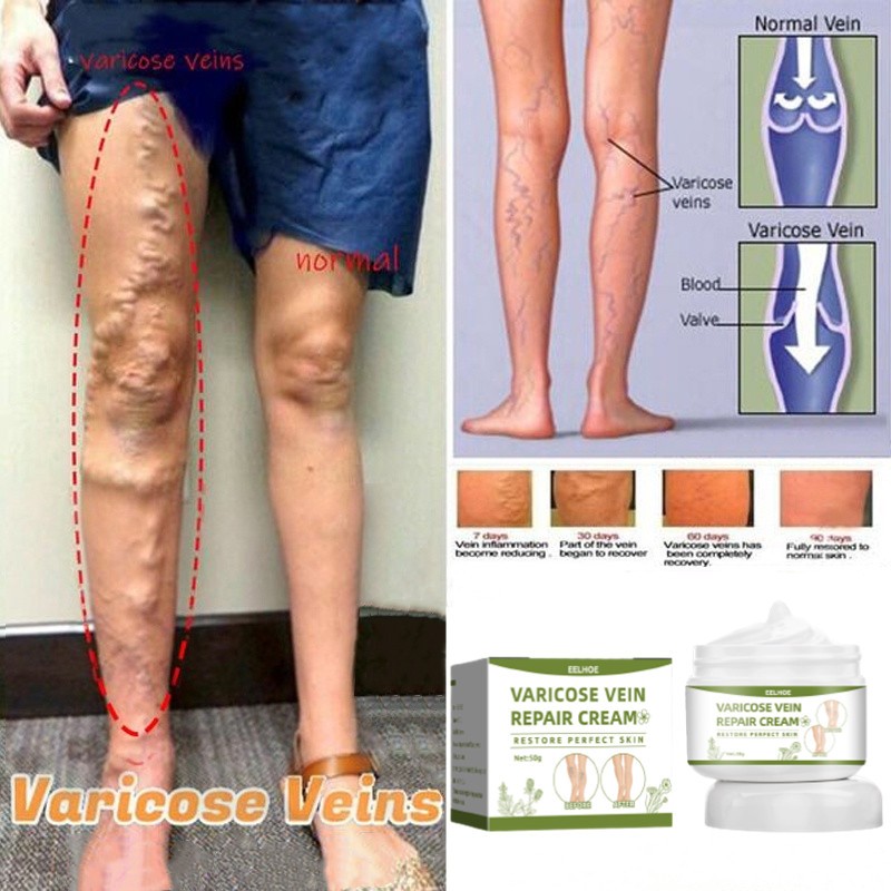 Jual Obat Varises di Kaki Varicose Veins Cream Salep penghilang Varises ...