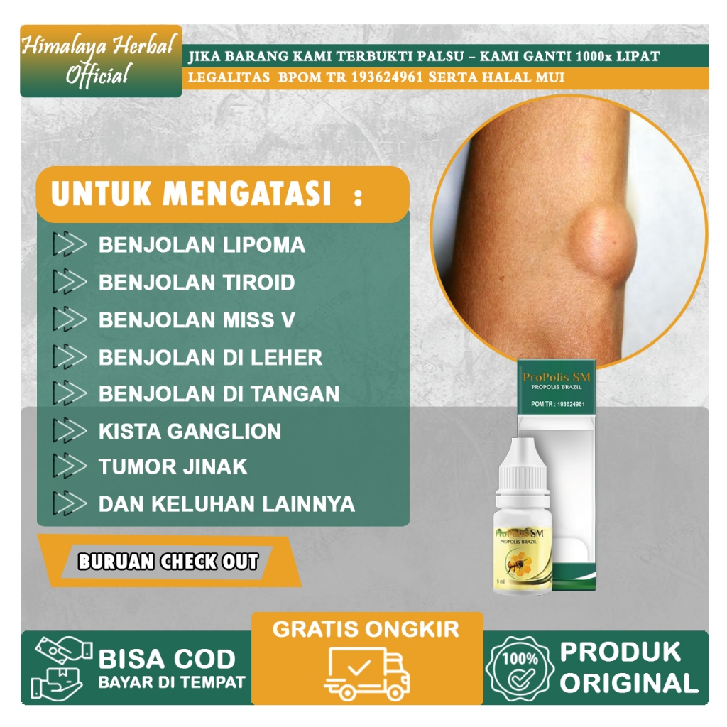 Jual Obat Benjolan Lipoma Penghancur Benjolan Di Tangan Kista Ganglion ...
