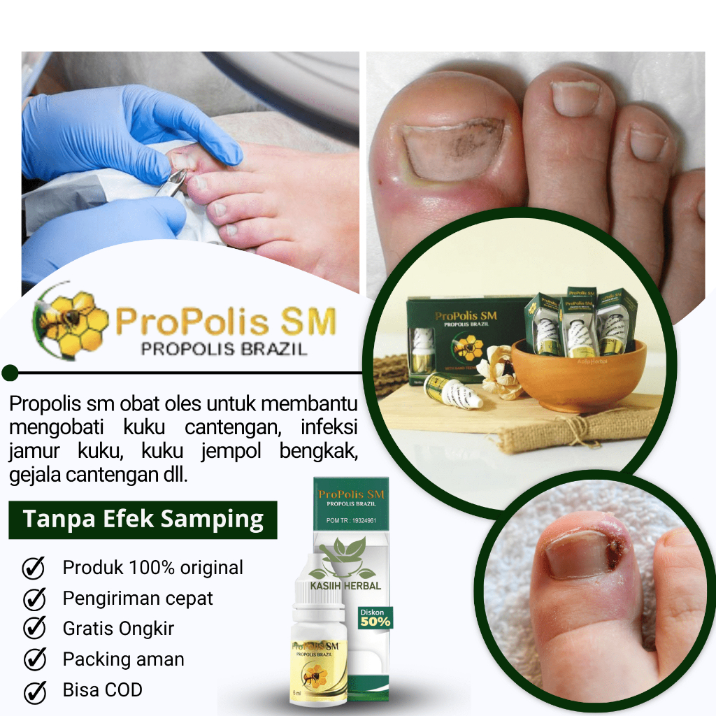Jual Obat Oles Cantengan Kuku Jempol Bengkak Infeksi Jamur / Kuku Kaki ...