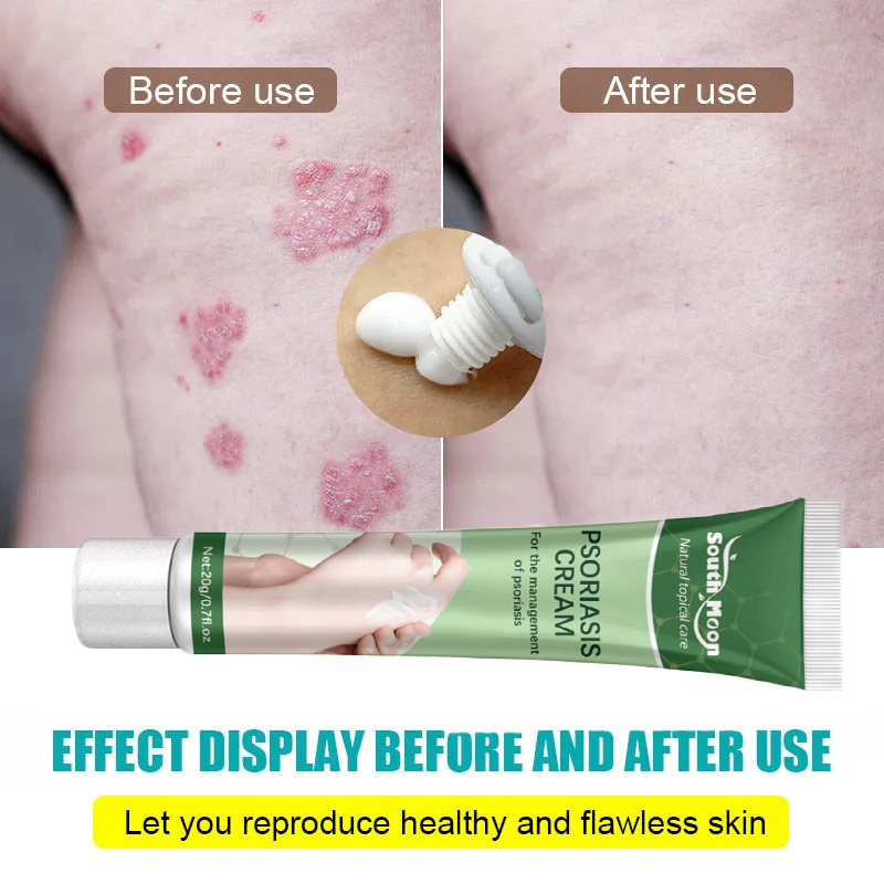 Jual Obat Psoriasis Salep Psoriasis Obat Gatal Kulit Formula Herbal ...