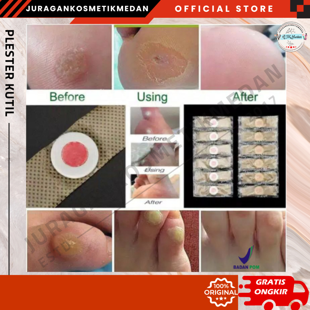 Jual 6PCS PLESTER KUTIL MATA IKAN FOOT CORN REMOVAL JI YAN TIE | Shopee ...