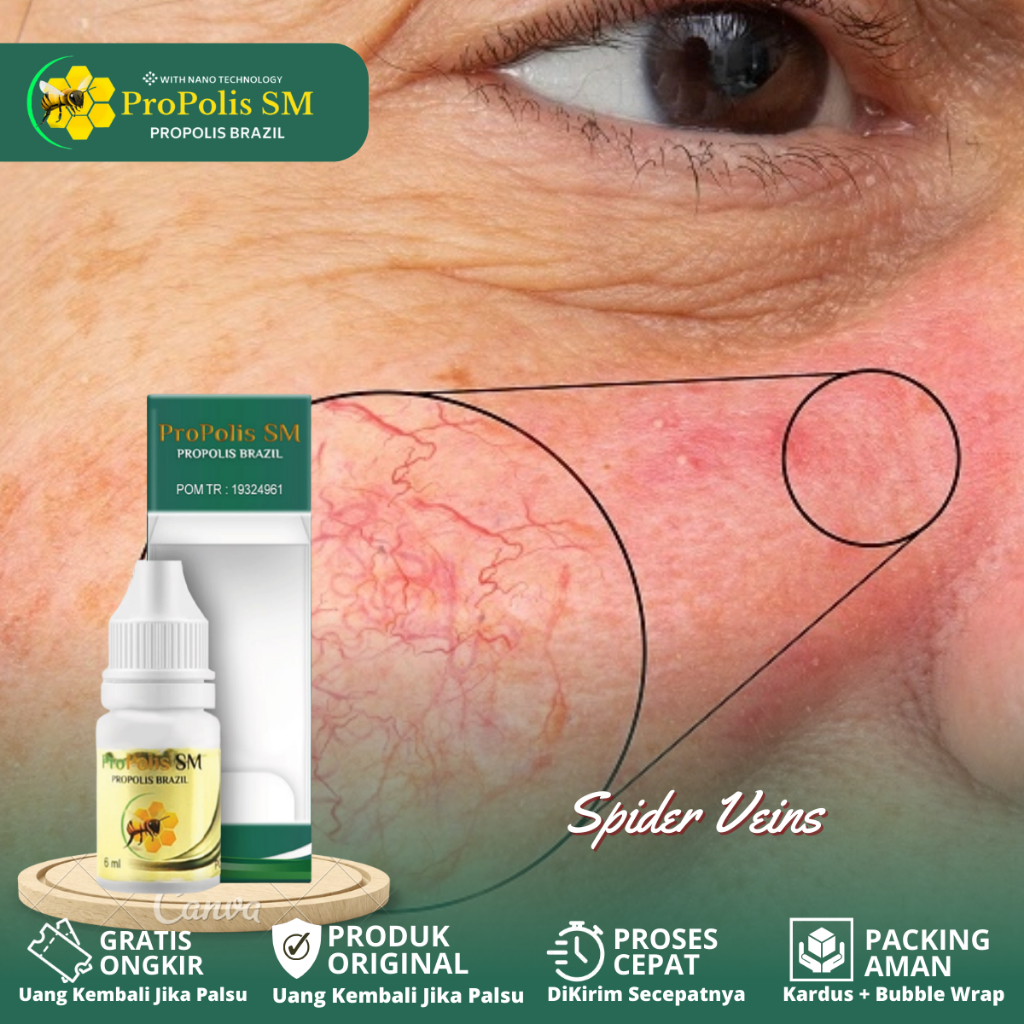 Jual Obat Spider Veins, Penghilang Spider Veins/Urat Halus Muka, Herbal ...